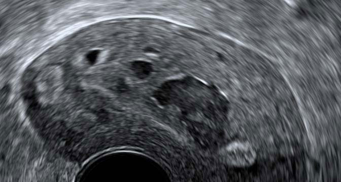 Ultrasound For Heavy Periods Management Options Of Fibroid Related